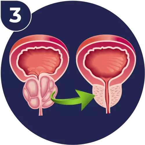 Prosterite - Site Oficial - Suporte Natural em Gotas para a Próstata
